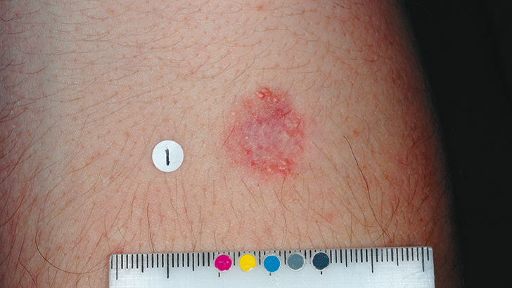Nodular BCC on Temple and Brachium | Erivedge® (vismodegib)