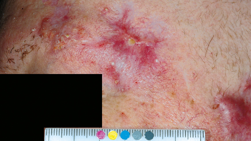 Nodular and Infiltrative BCC on Eyebrow and Preauricular Area ...