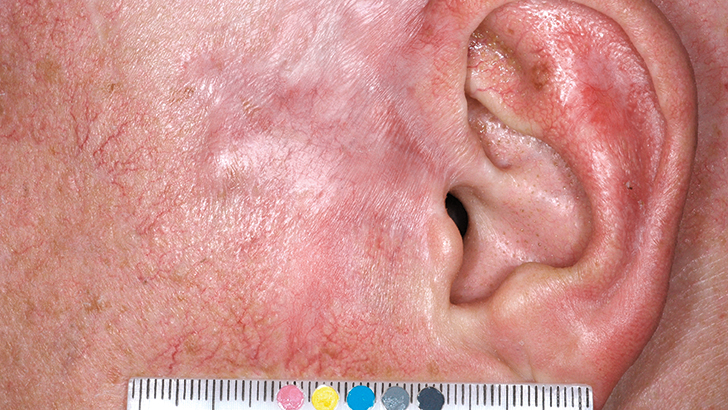 Nodular and Infiltrative BCC on Eyebrow and Preauricular Area ...