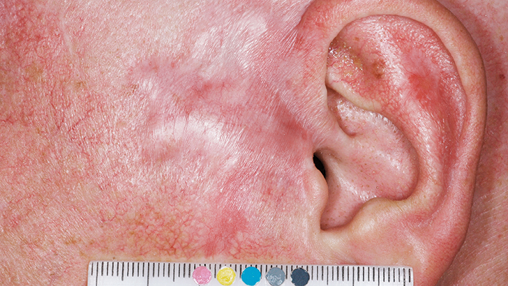Nodular and Infiltrative BCC on Eyebrow and Preauricular Area ...