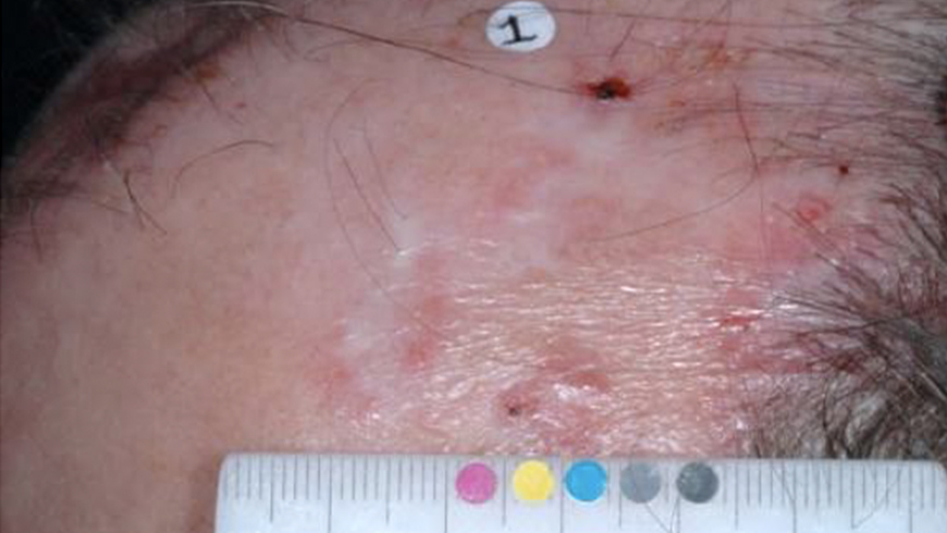 Superficial BCC on Scalp | Erivedge® (vismodegib)