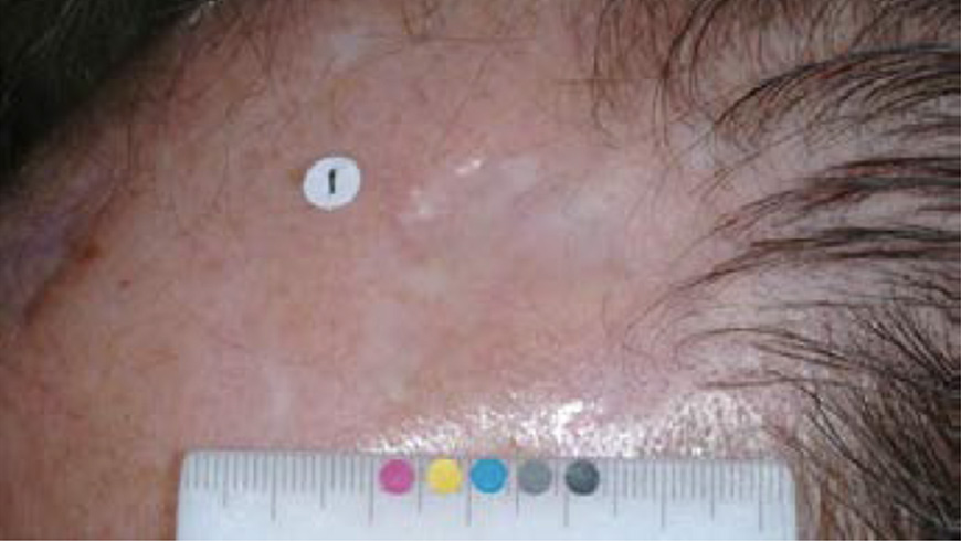 Superficial BCC on Scalp | Erivedge® (vismodegib)