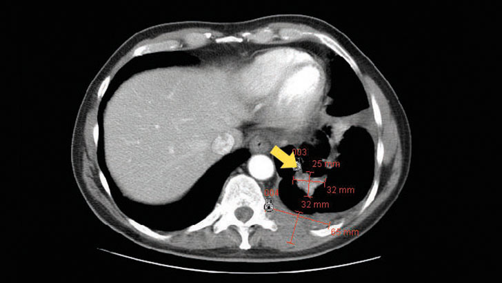 Metastatic BCC on Lung | Erivedge® (vismodegib)