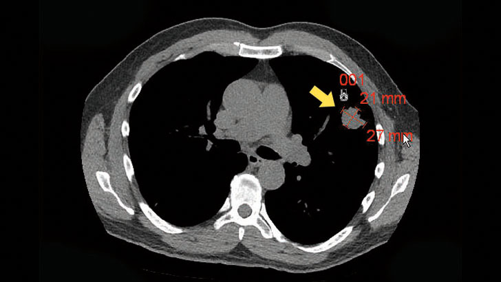 Metastatic BCC on Lung | Erivedge® (vismodegib)