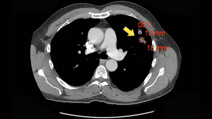 Metastatic BCC on Lung | Erivedge® (vismodegib)