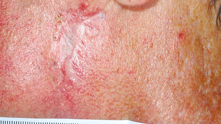 Nodular and Infiltrative BCC on Cheek | Erivedge® (vismodegib)