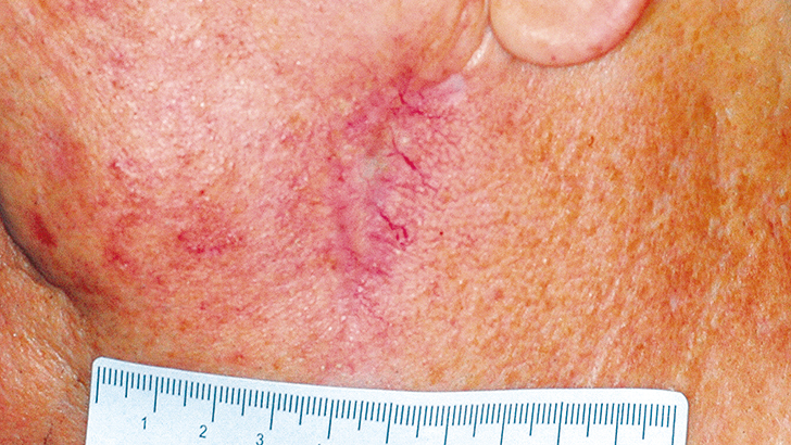 Nodular and Infiltrative BCC on Cheek | Erivedge® (vismodegib)