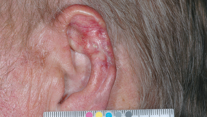 Infiltrative BCC on Ear | Erivedge® (vismodegib)