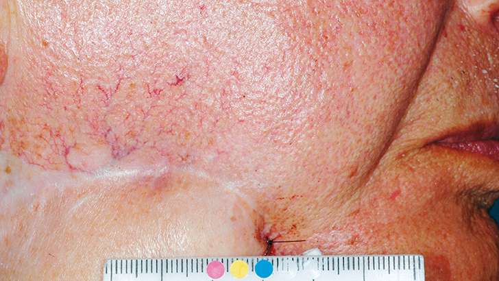 Nodular and Infiltrative BCC on Neck | Erivedge® (vismodegib)