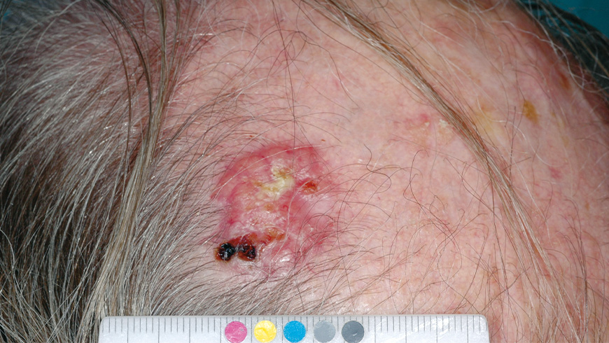 Confirmed BCC on Crown of Skull | Erivedge® (vismodegib)