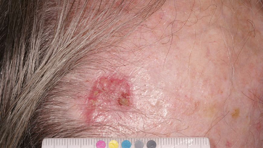 Confirmed BCC on Crown of Skull | Erivedge® (vismodegib)