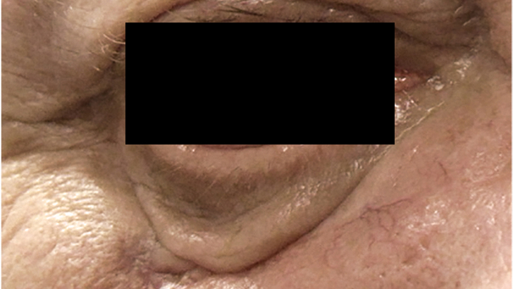 Advanced BCC on Eyelid | Erivedge® (vismodegib)