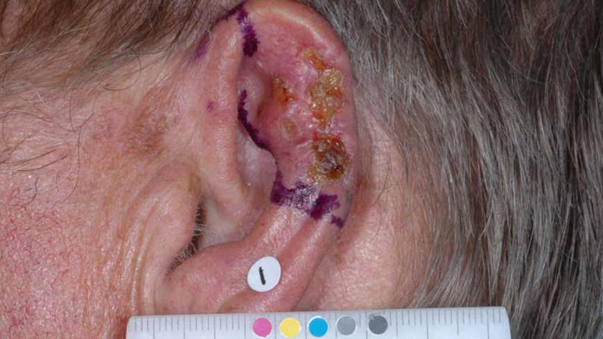 Infiltrative BCC on Ear | Erivedge® (vismodegib)