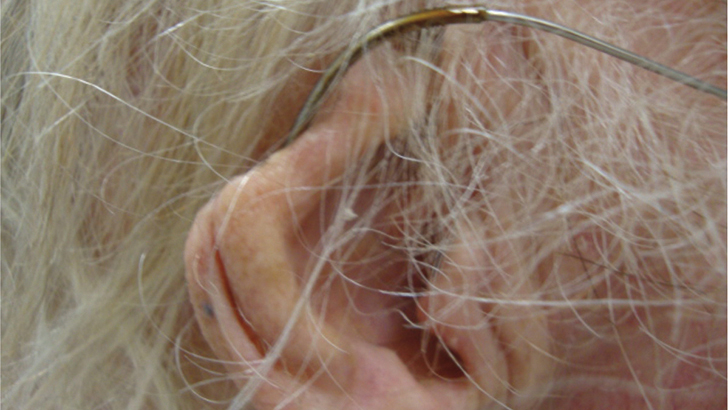 Advanced BCC on Forehead, Ear, and Tibial Area | Erivedge® (vismodegib)