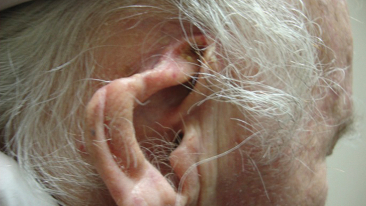 Advanced BCC on Forehead, Ear, and Tibial Area | Erivedge® (vismodegib)