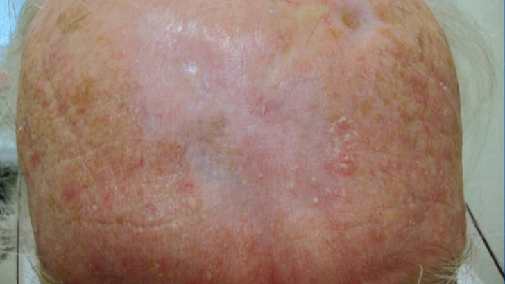 Advanced BCC on Forehead, Ear, and Tibial Area | Erivedge® (vismodegib)