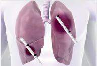 Clinical Results | Erivedge® (vismodegib)